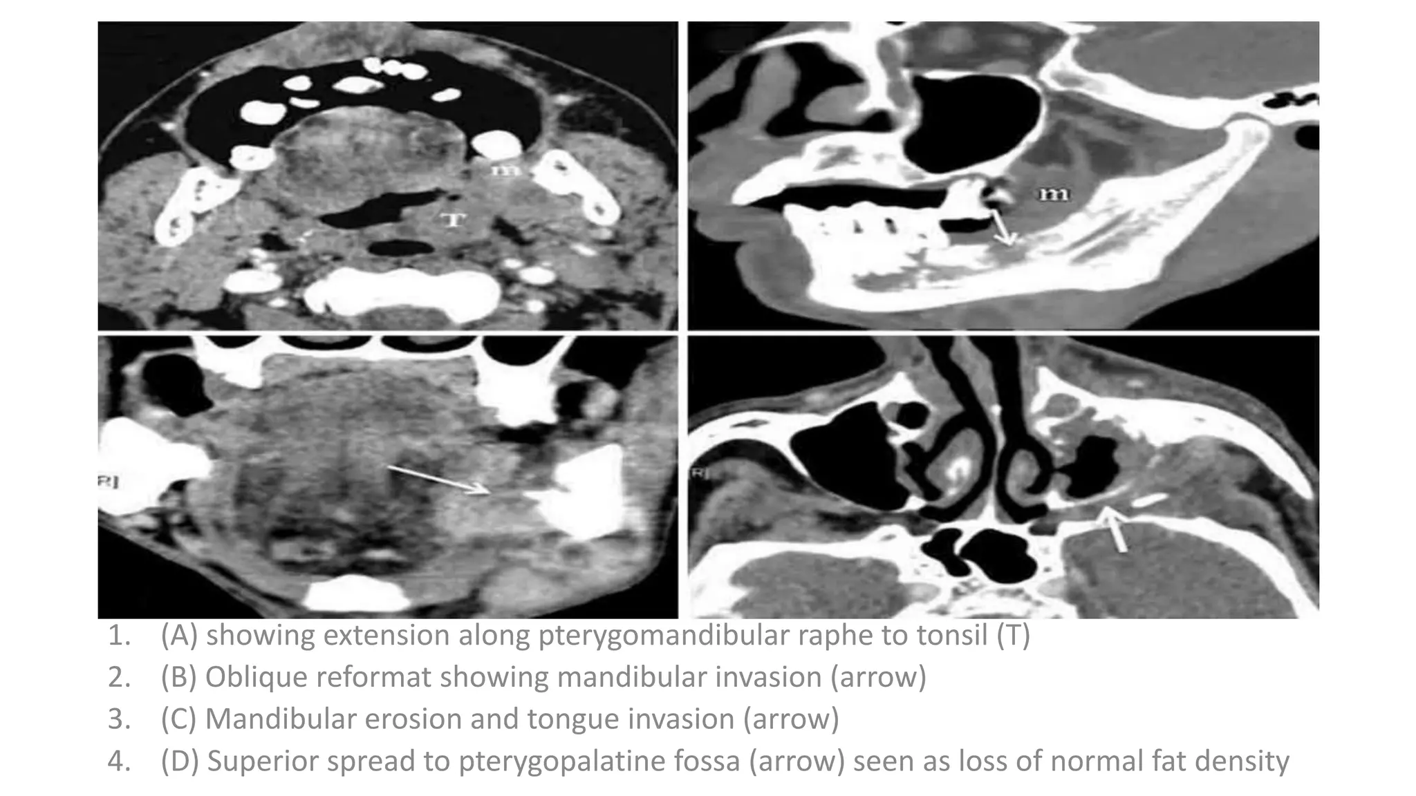 Normal Anatomy of Buccal mucosa and cancer | PPTX