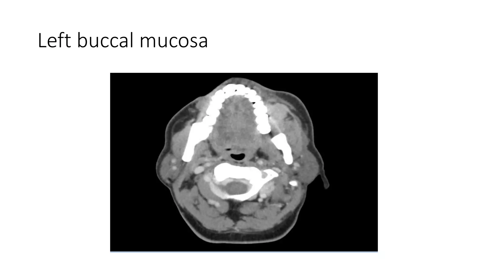 Normal Anatomy of Buccal mucosa and cancer | PPTX