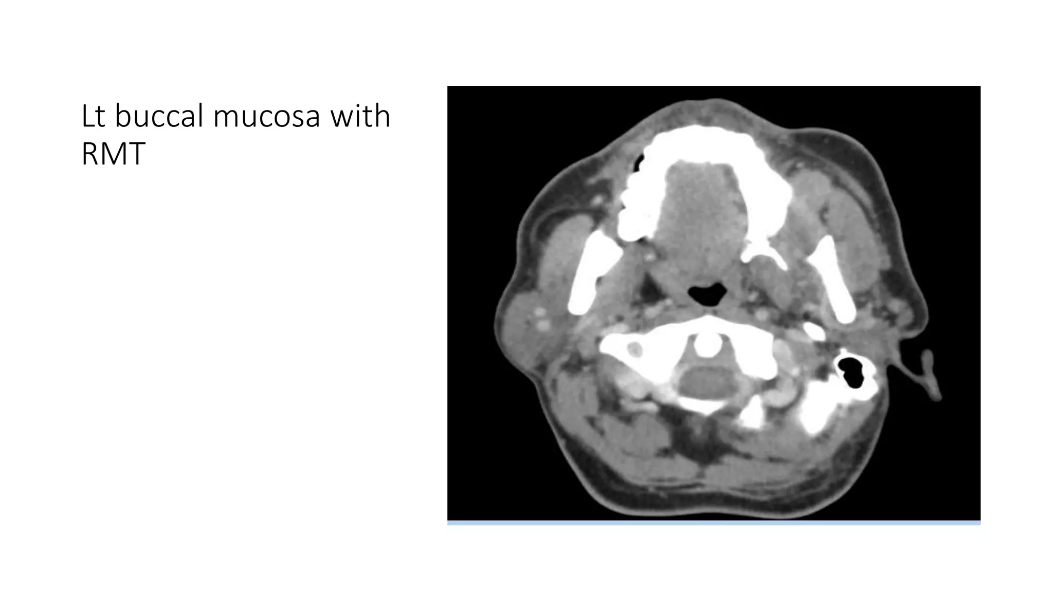 Normal Anatomy of Buccal mucosa and cancer | PPTX