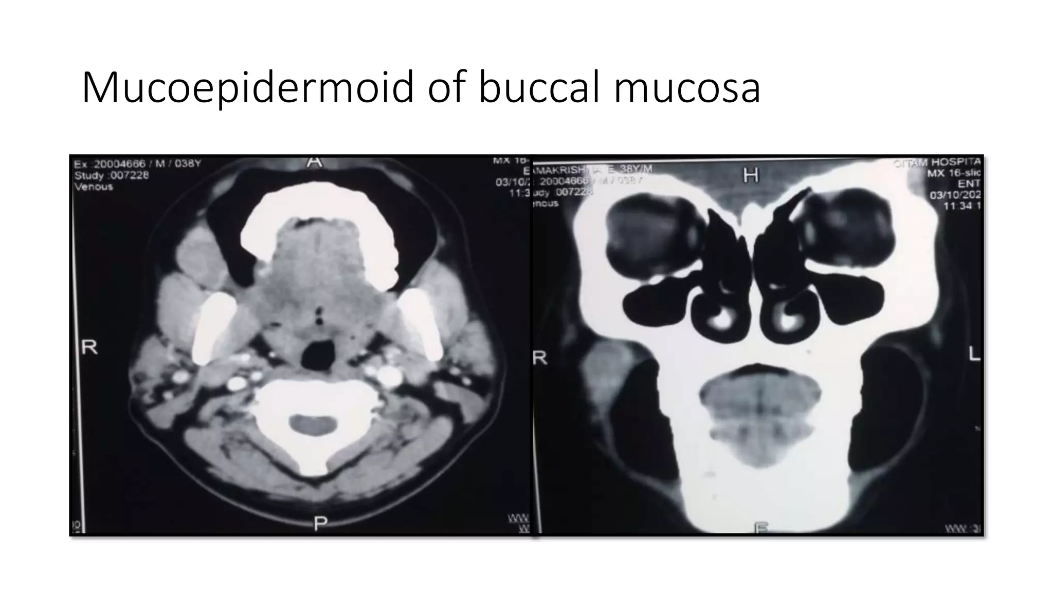 Normal Anatomy of Buccal mucosa and cancer | PPTX