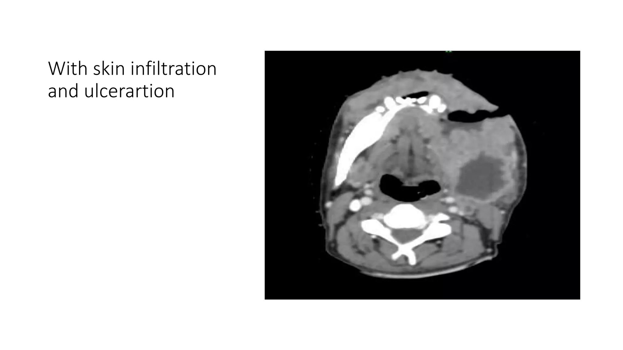 Normal Anatomy Of Buccal Mucosa And Cancer Ppt