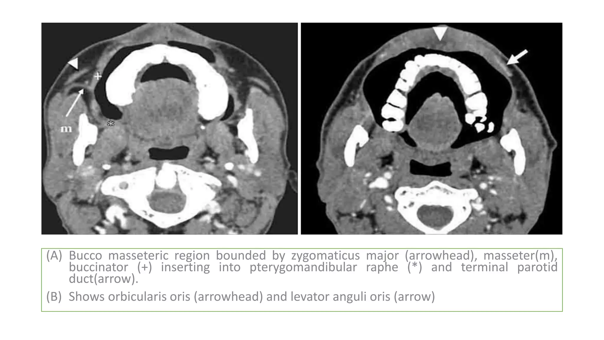 Normal Anatomy of Buccal mucosa and cancer | PPTX