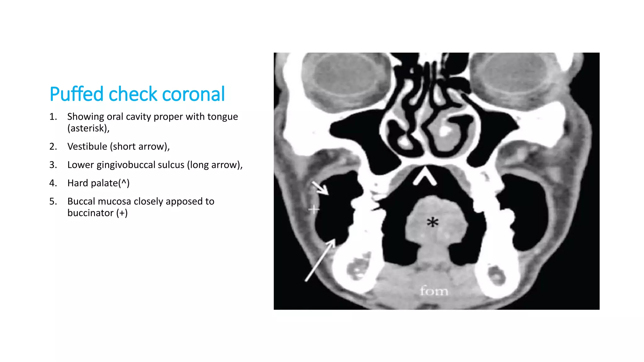 Normal Anatomy of Buccal mucosa and cancer | PPTX