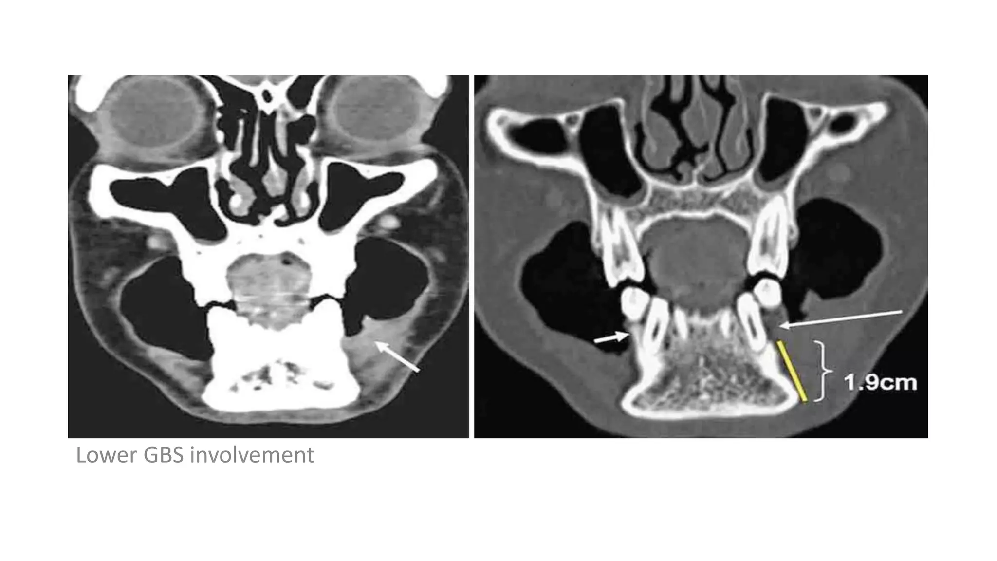Normal Anatomy of Buccal mucosa and cancer | PPTX