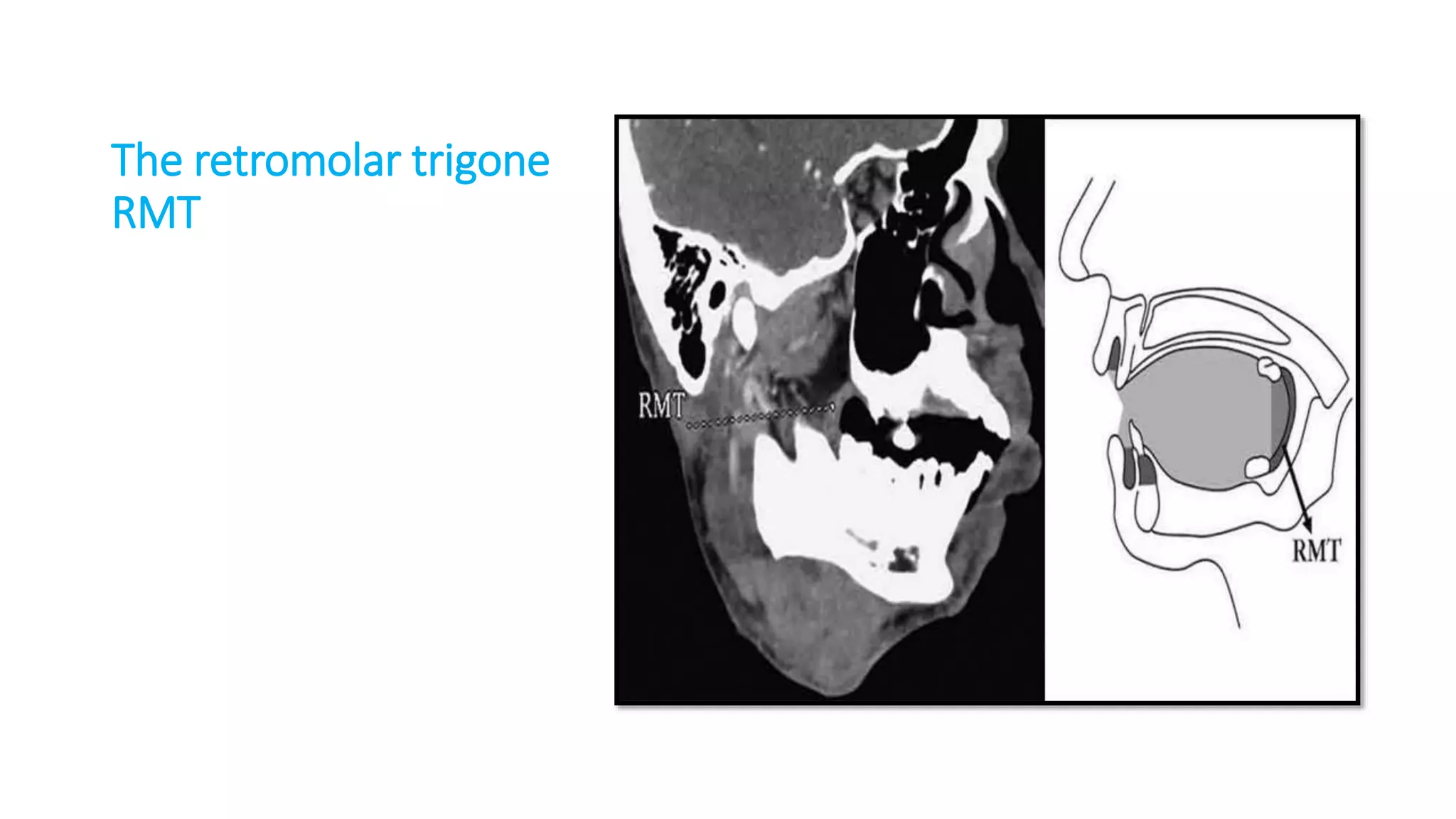 Normal Anatomy of Buccal mucosa and cancer | PPTX