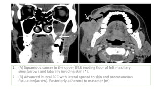 Normal Anatomy of Buccal mucosa and cancer | PPTX