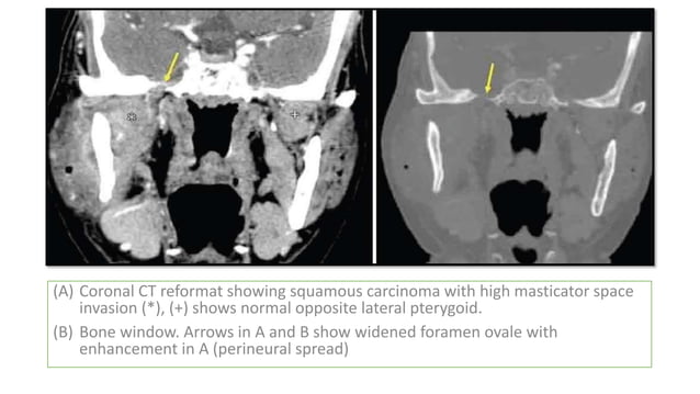 Normal Anatomy of Buccal mucosa and cancer | PPTX | Dental Health ...