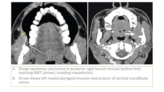 Normal Anatomy of Buccal mucosa and cancer | PPTX | Dental Health ...