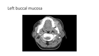 Normal Anatomy of Buccal mucosa and cancer | PPTX