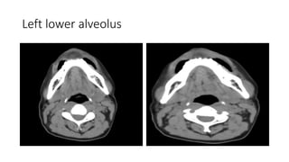 Normal Anatomy of Buccal mucosa and cancer | PPTX
