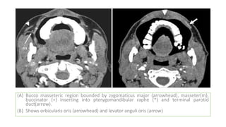 Normal Anatomy of Buccal mucosa and cancer | PPTX