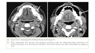 Normal Anatomy of Buccal mucosa and cancer | PPTX