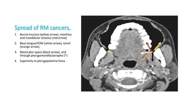 Normal Anatomy of Buccal mucosa and cancer | PPTX | Dental Health ...