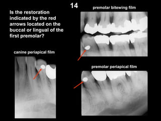 Buccal Object Rule | PPT