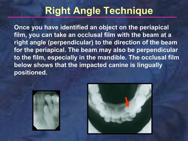 Buccal Object Rule | PPT