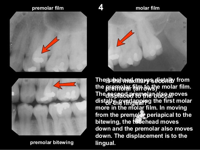 Buccal Object Rule