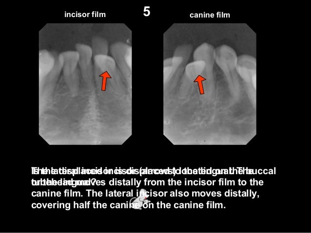Buccal Object Rule