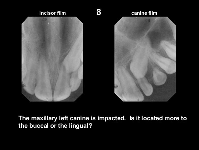 Buccal Object Rule
