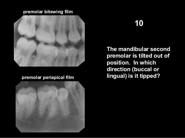 Buccal Object Rule