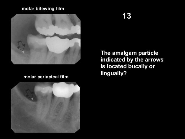 Buccal Object Rule