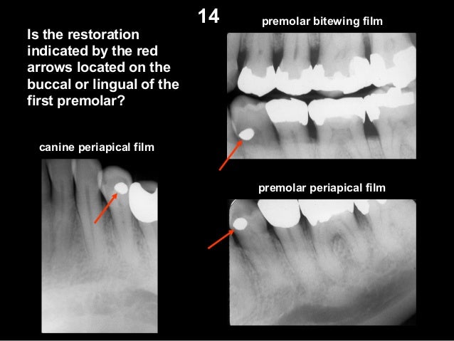 Buccal Object Rule