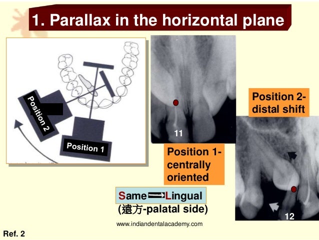 Buccal object rule /endodontic courses