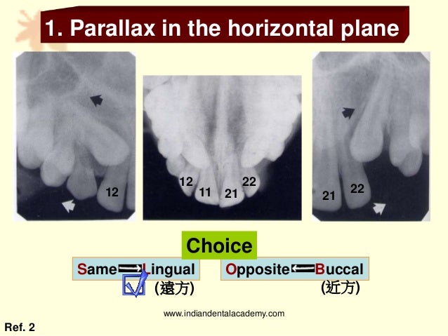 Buccal object rule /endodontic courses