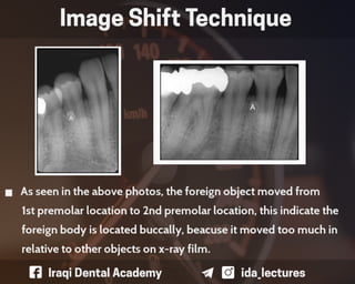 Buccal Object Rule - A Radiographic Aid in Dental Practice. | PDF