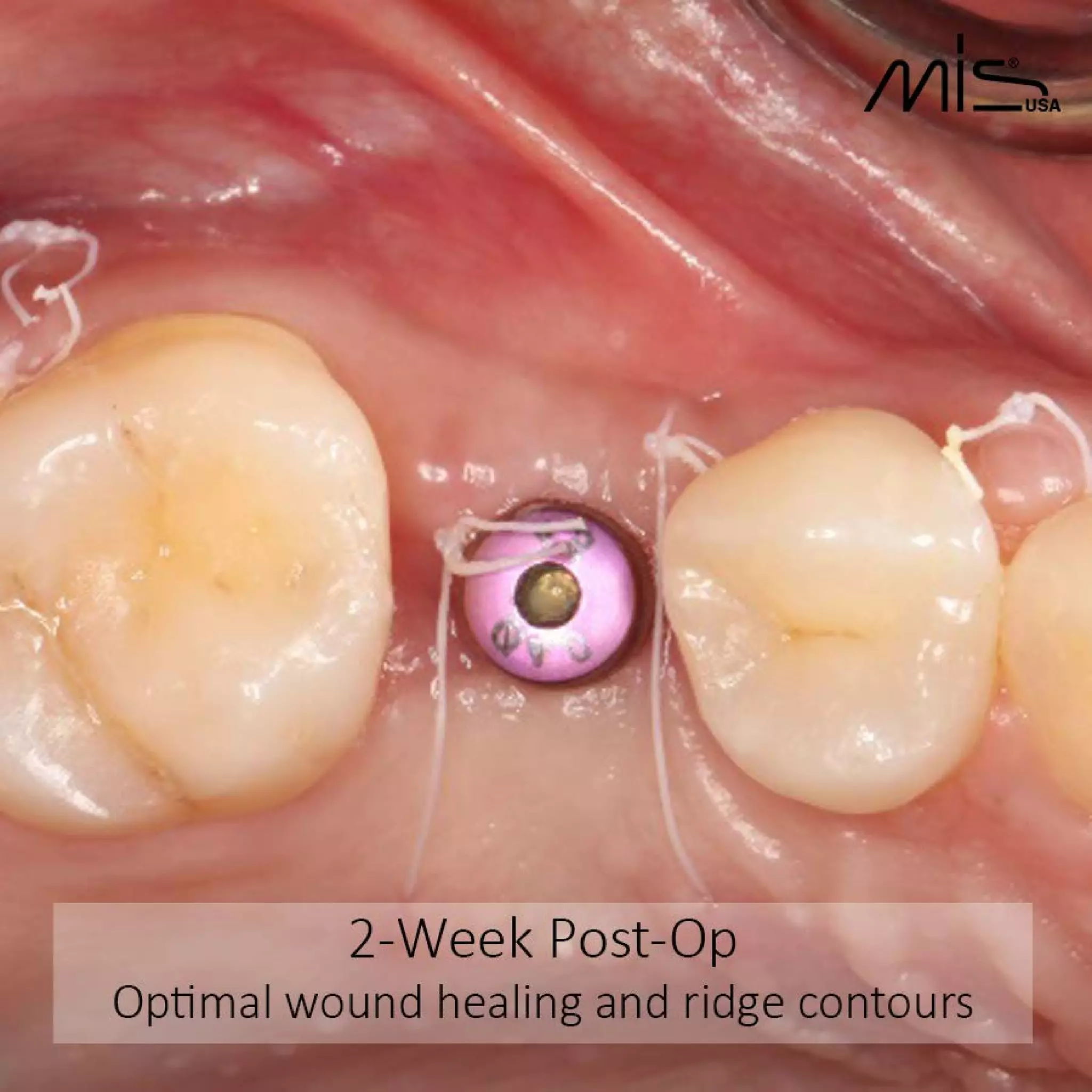 OSSIX VOLUMAX Buccal Ridge Deficiency Case | PDF | Dental Health ...