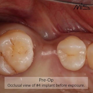 OSSIX VOLUMAX Buccal Ridge Deficiency Case | PDF | Dental Health ...