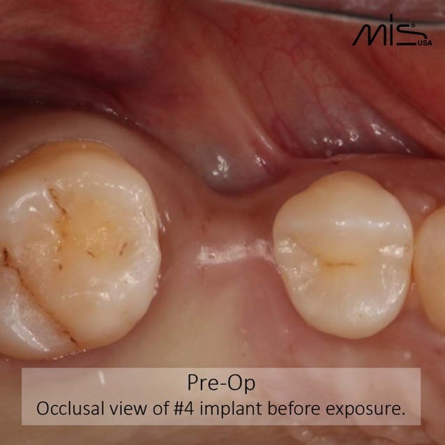 OSSIX VOLUMAX Buccal Ridge Deficiency Case | PDF | Dental Health ...