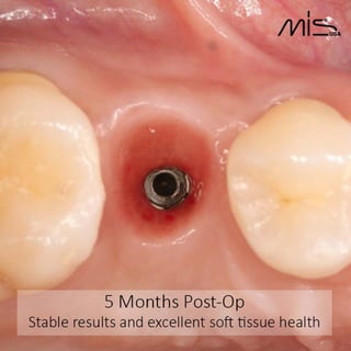 OSSIX VOLUMAX Buccal Ridge Deficiency Case | PDF | Dental Health ...