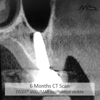 OSSIX VOLUMAX Buccal Ridge Deficiency Case | PDF | Dental Health ...