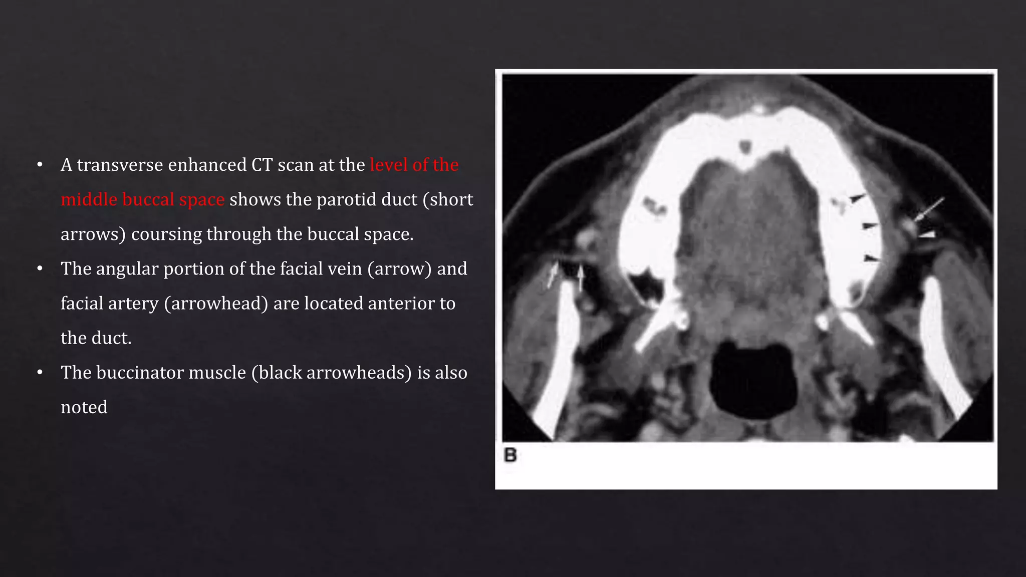Buccal space anatomy | PPTX