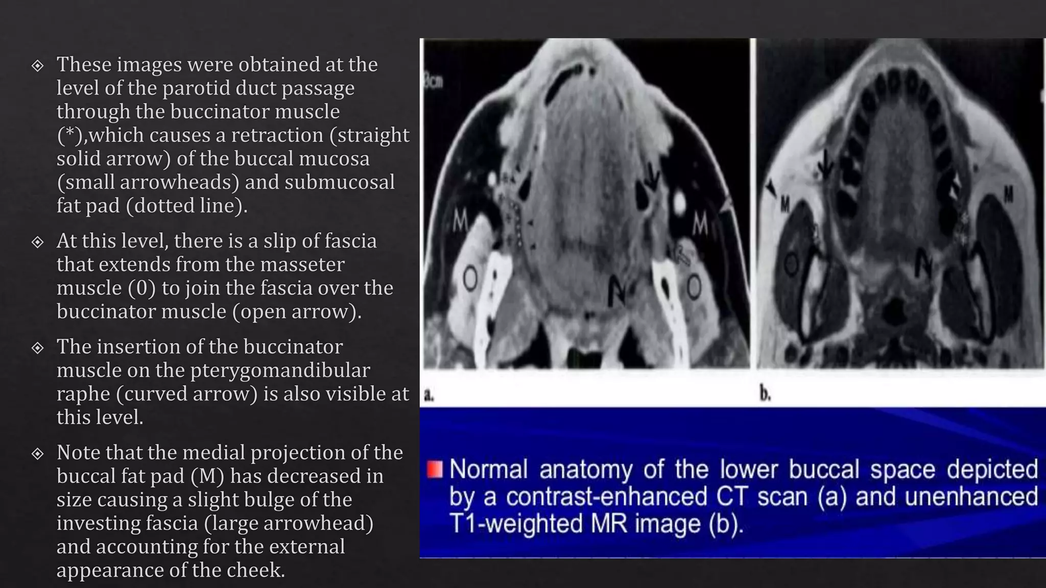 Buccal space anatomy | PPTX