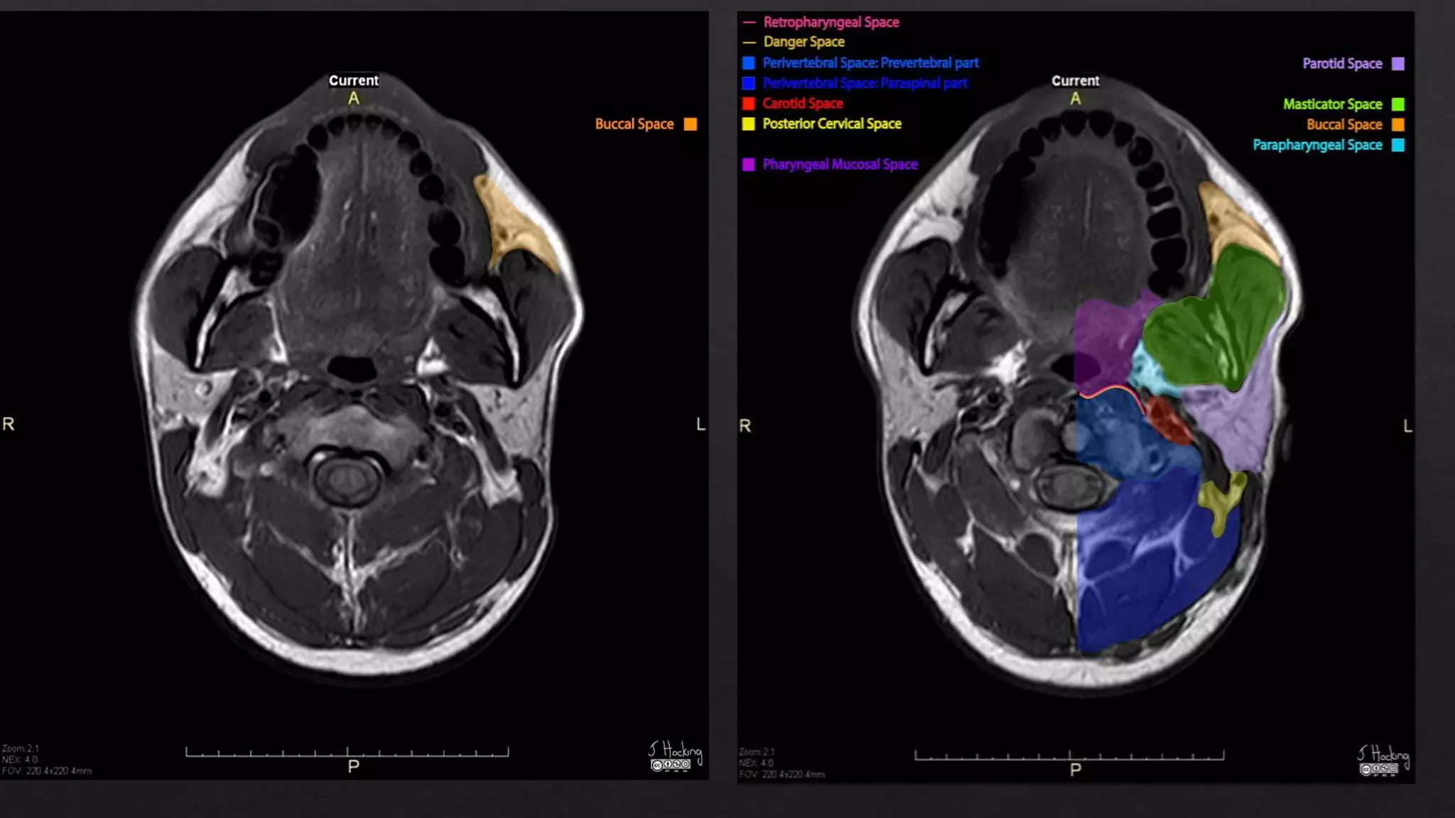 Buccal space anatomy | PPTX