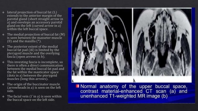 Buccal space anatomy | PPTX | Ear, Nose and Throat Conditions ...