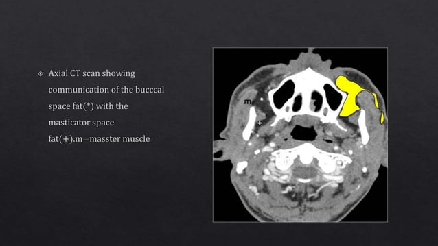 Buccal space anatomy | PPTX | Ear, Nose and Throat Conditions ...