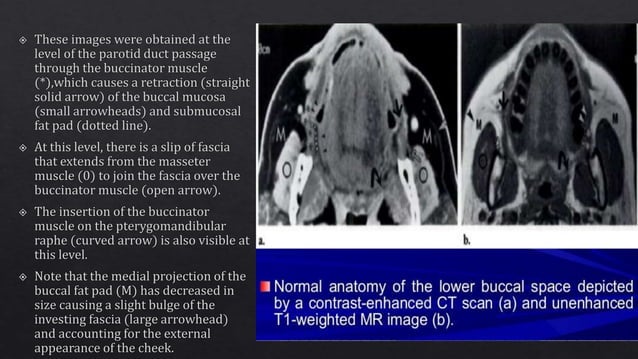 Buccal space anatomy | PPTX | Ear, Nose and Throat Conditions ...