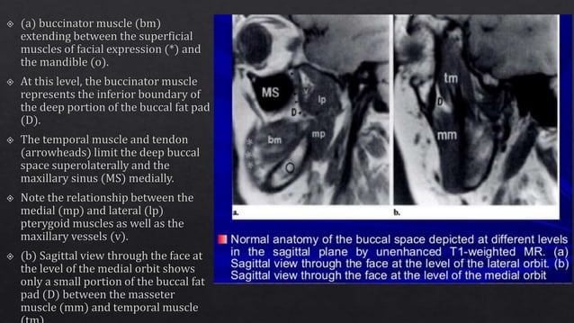 Buccal space anatomy | PPTX | Ear, Nose and Throat Conditions ...