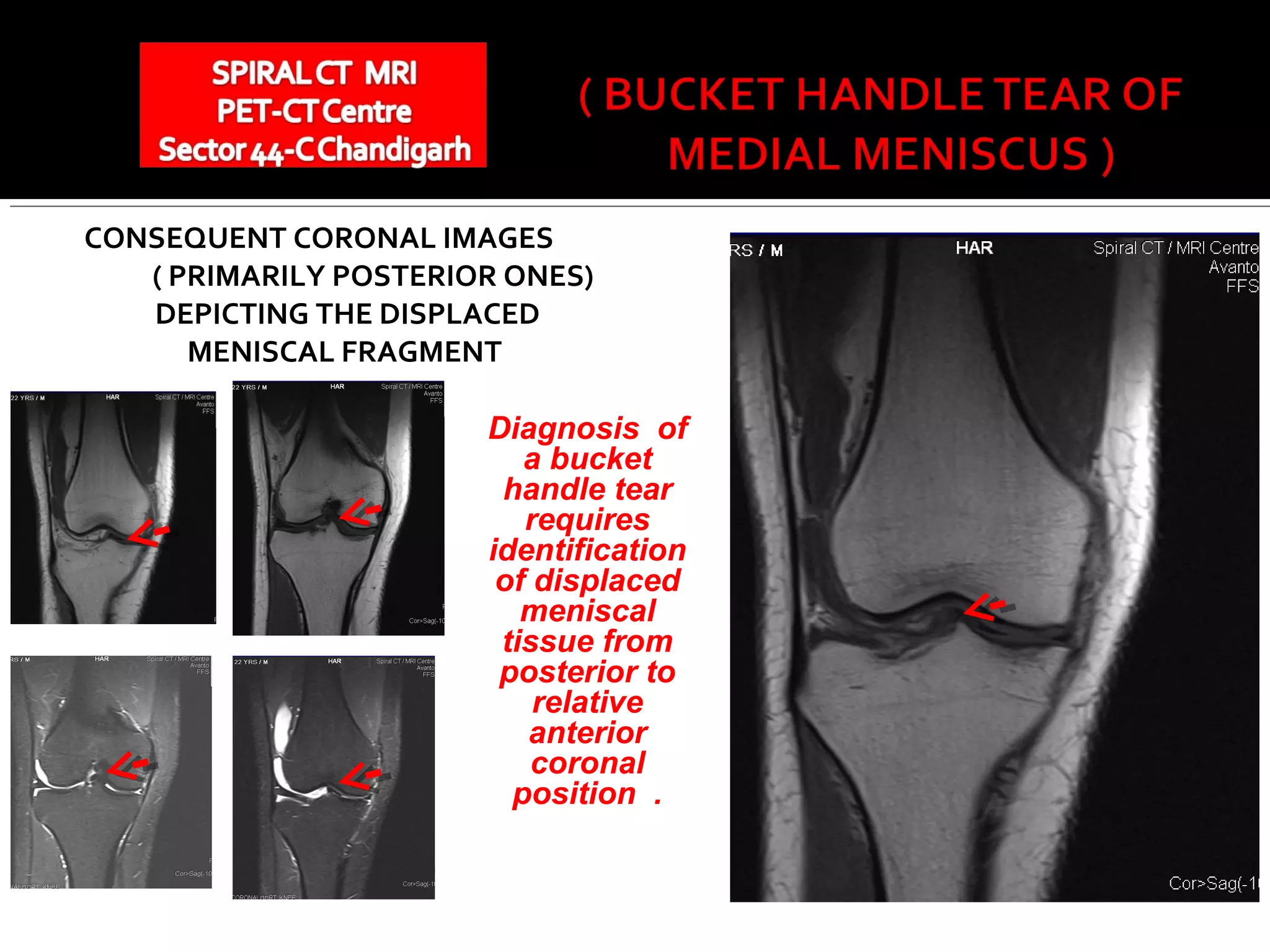 Bucket handle tear | PPT