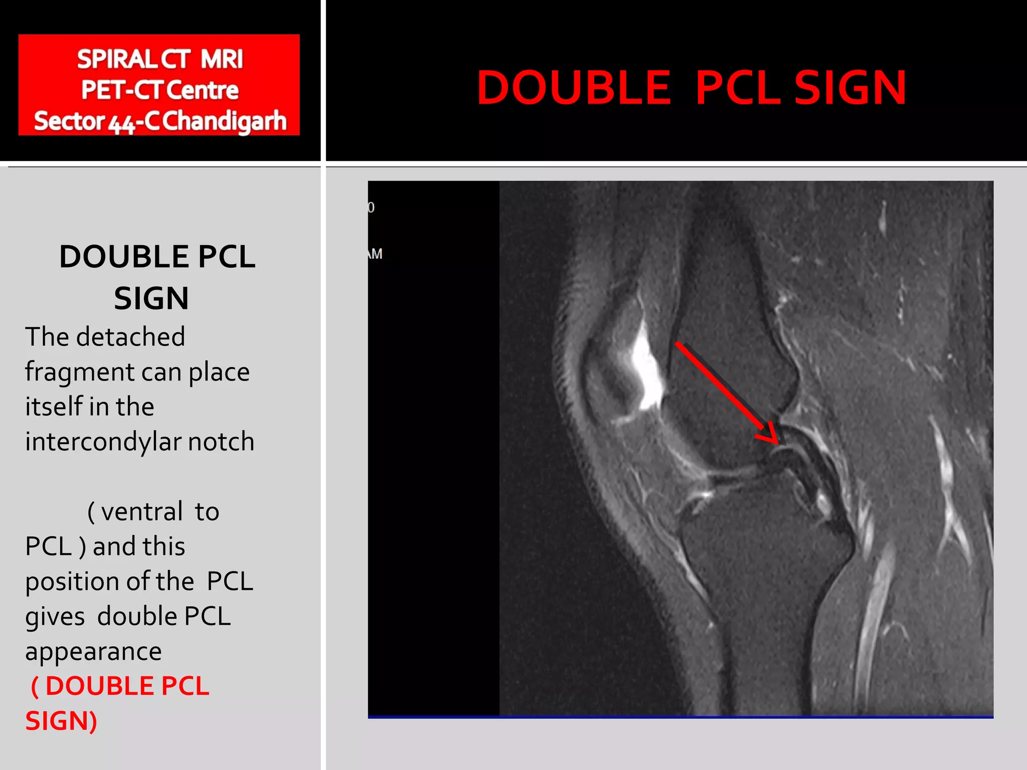 Bucket handle tear | PPT
