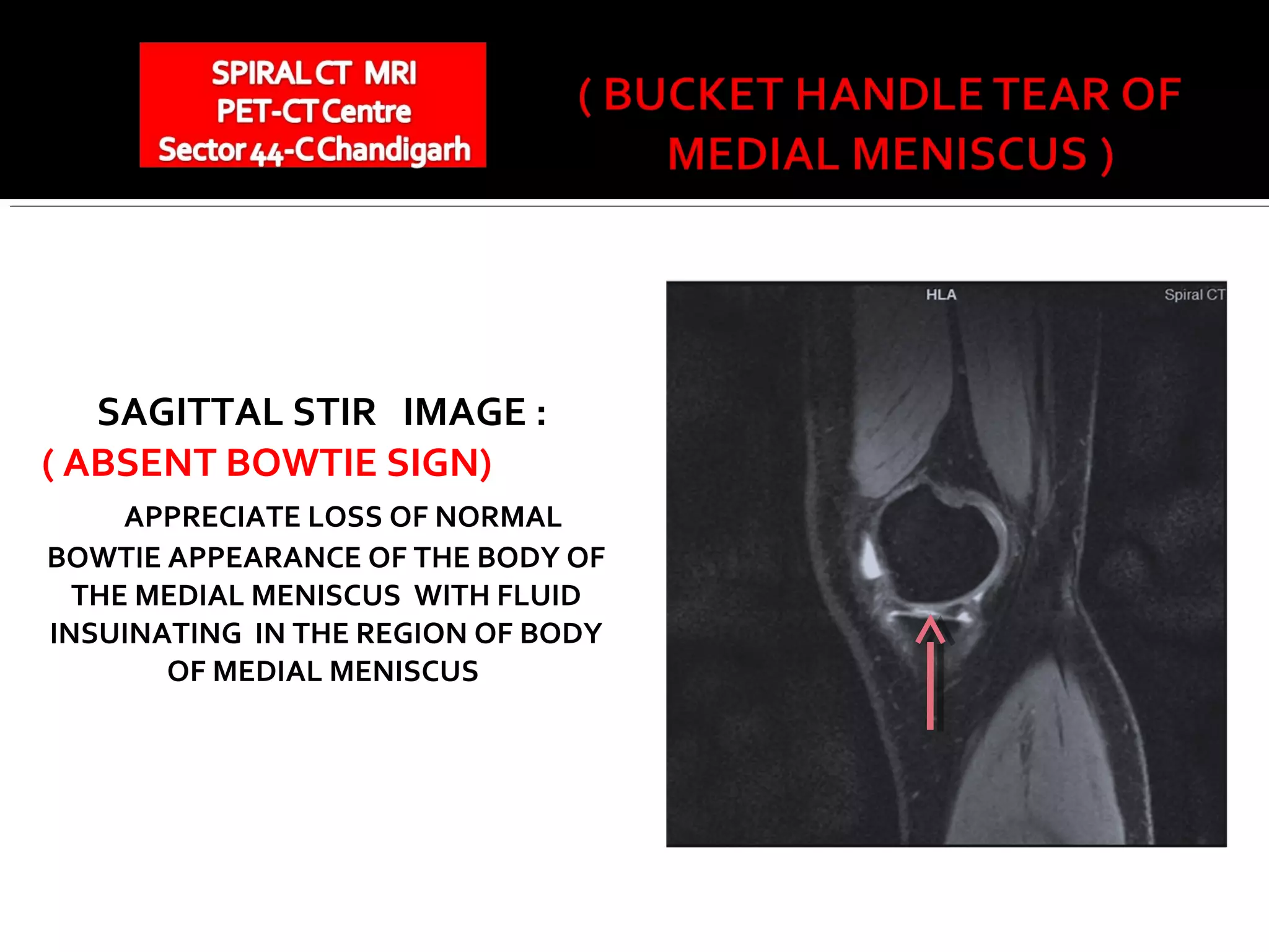 Bucket handle tear | PPT