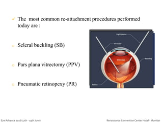 SCLERAL Buckling DR AJAY DUDANI | PPTX