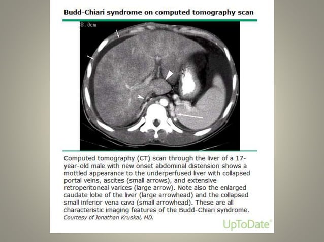 Budd chiari syndrome | PPTX | Digestive Disorders | Diseases and Conditions