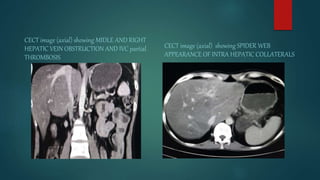 BUDD-CHIARI SYNDROME POSTER NEW.pptx | Blood Disorders | Diseases and ...