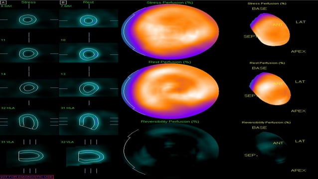 MPI , nuclear cardiac | PDF | Heart and Cardiovascular Diseases ...