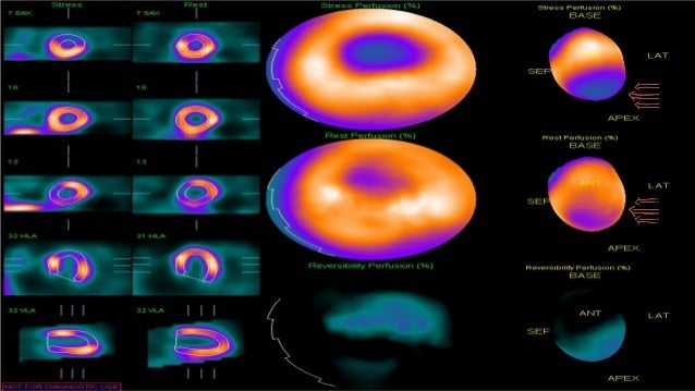 MPI , nuclear cardiac