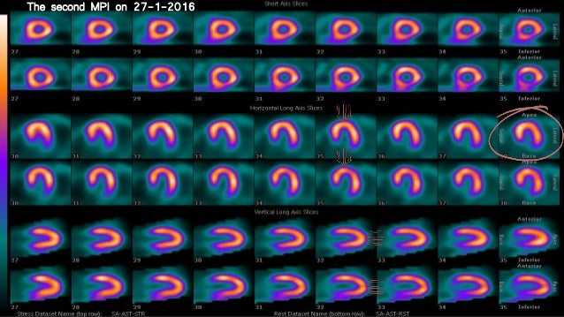 MPI , nuclear cardiac