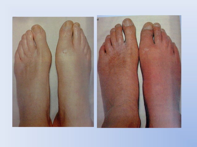 Buergers Disease Ppt